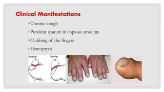 Bronchiectasis, lower respiratory disorders | PPT