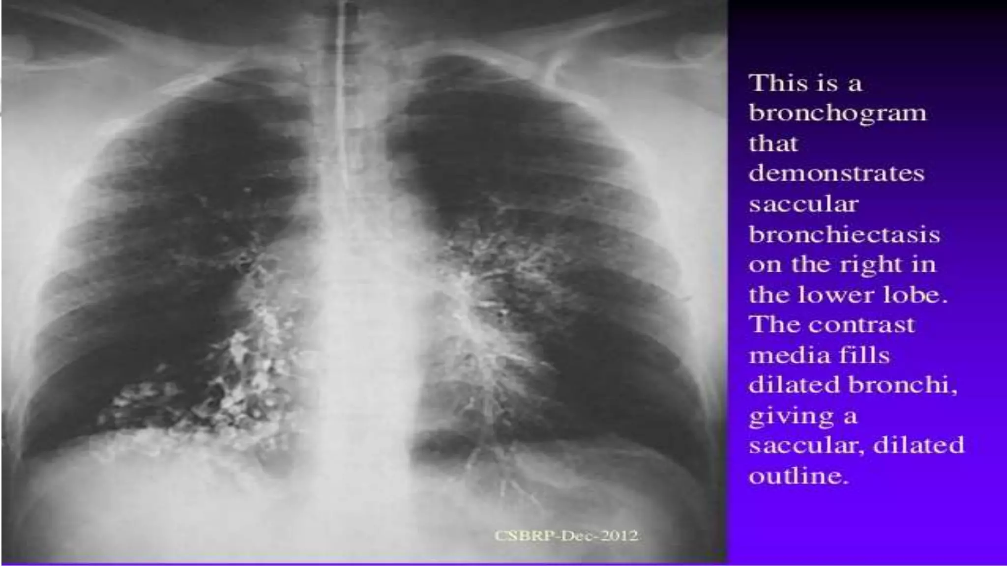 Bronchiectasis | PPT