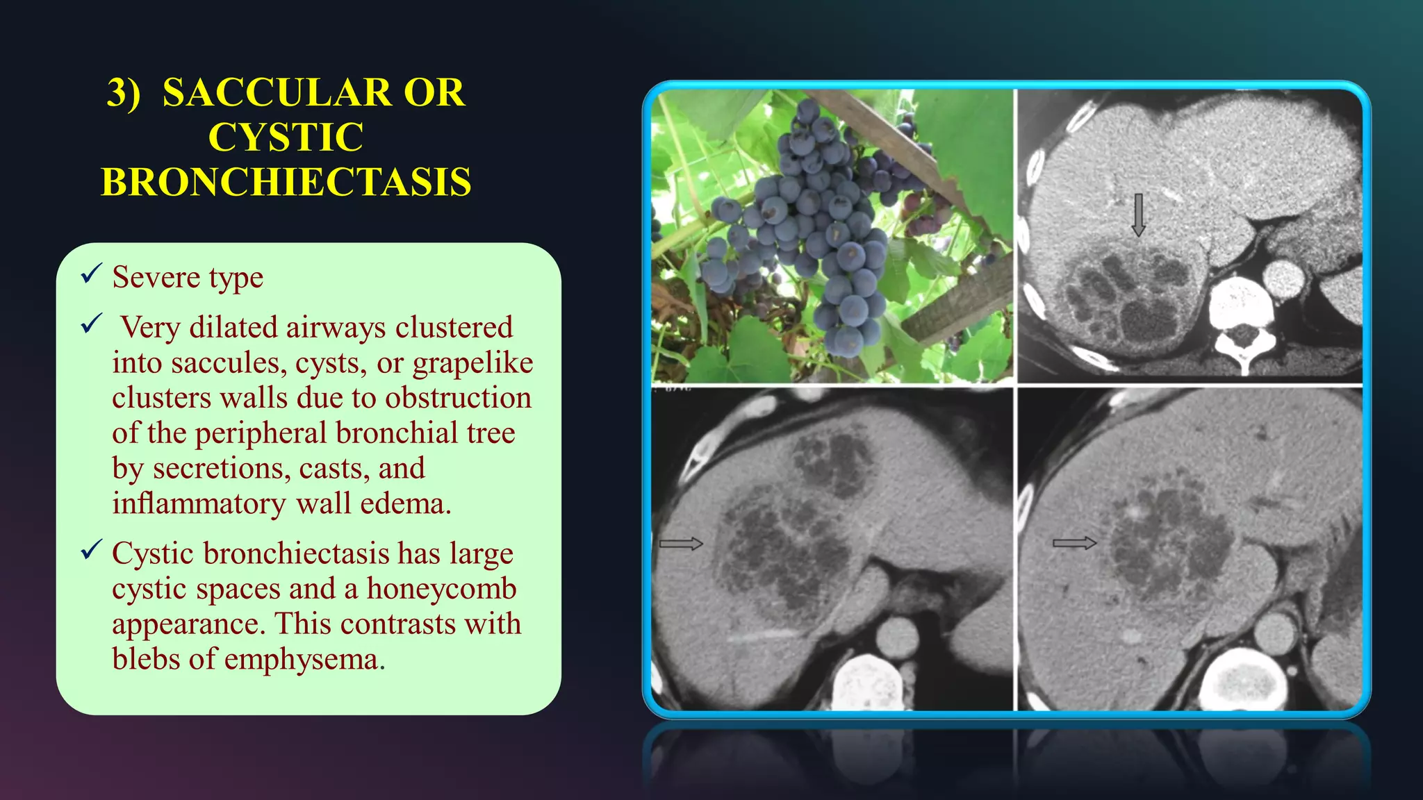 BRONCHIECTASIS | PDF