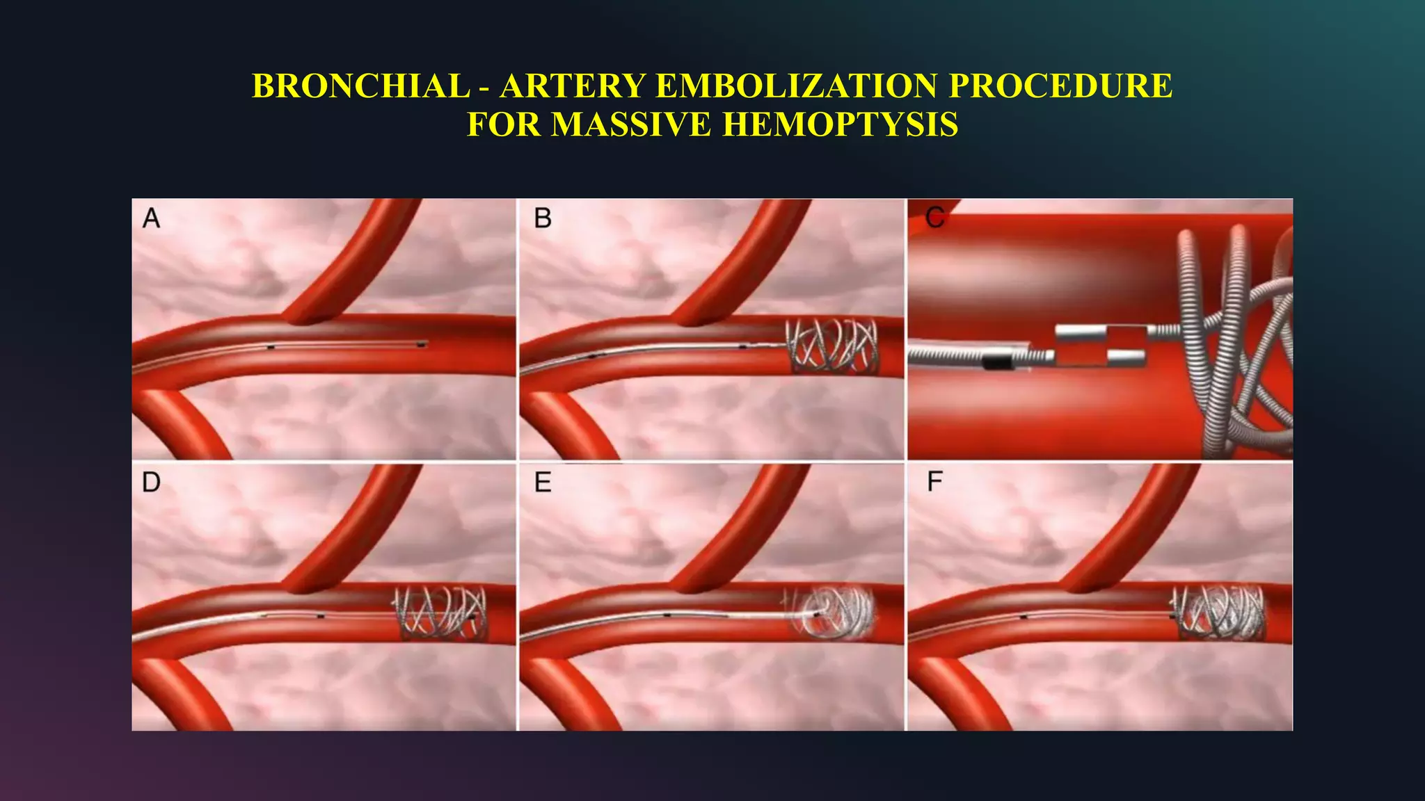 BRONCHIECTASIS | PDF