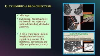 BRONCHIECTASIS | PDF | Lung and Respiratory Health | Diseases and ...