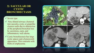 BRONCHIECTASIS | PDF