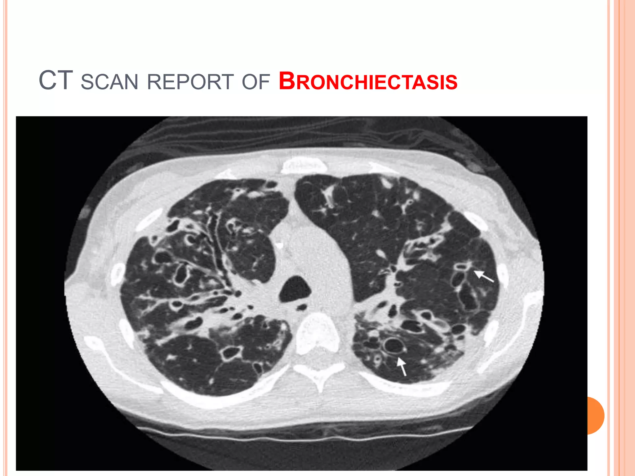 :Bronchiectasis : Nursing Management | PPTX