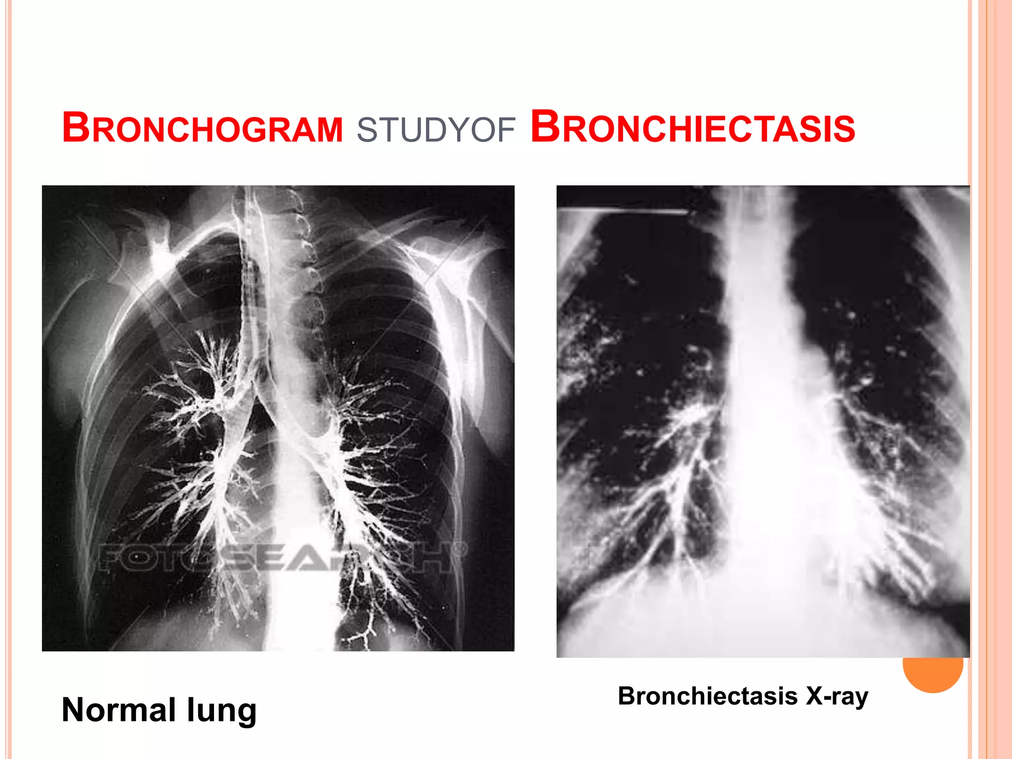 :Bronchiectasis : Nursing Management | PPTX