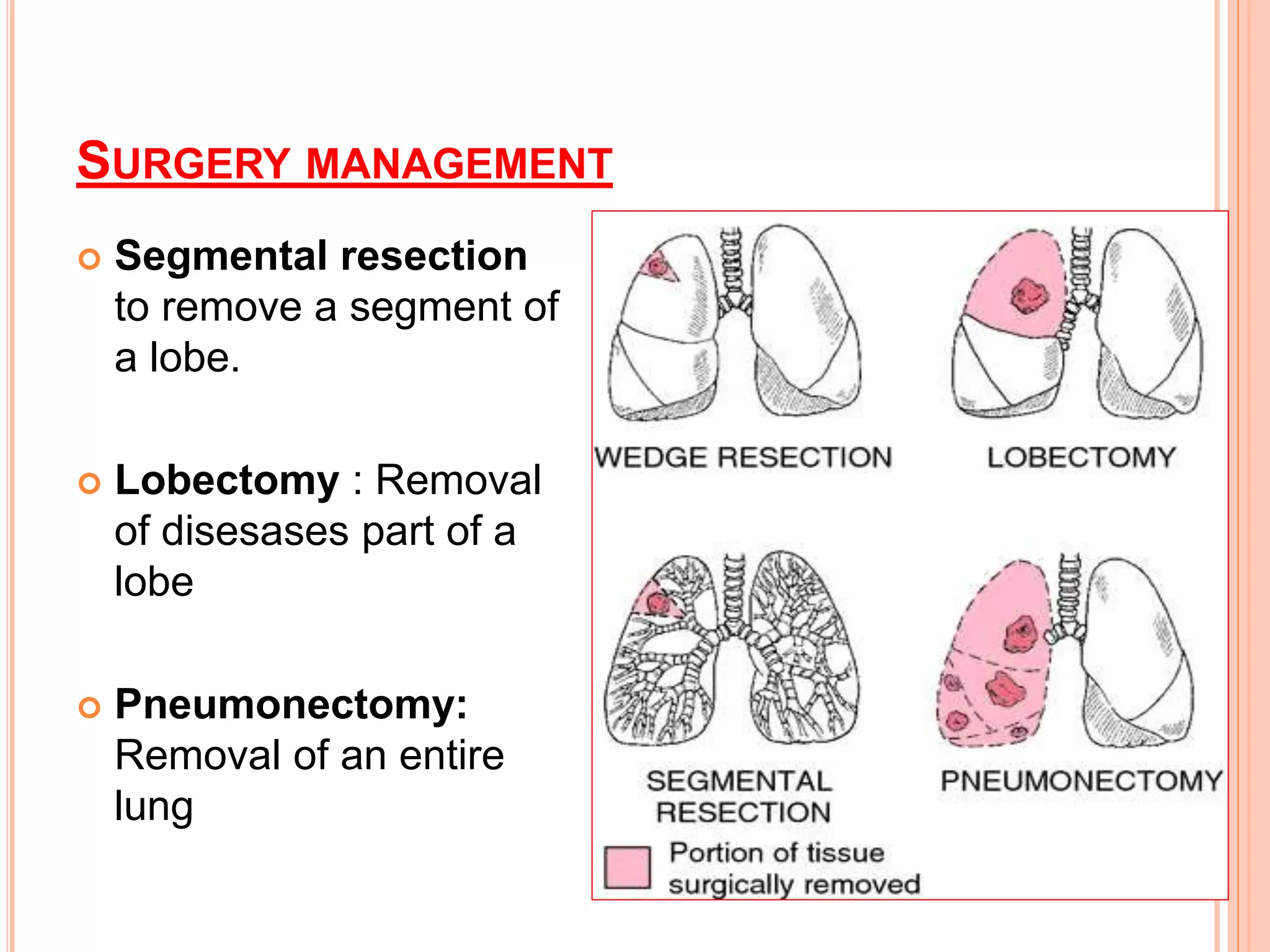 :Bronchiectasis : Nursing Management | PPTX