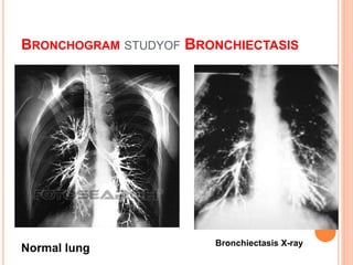 :Bronchiectasis : Nursing Management | PPTX