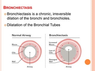 :Bronchiectasis : Nursing Management | PPTX