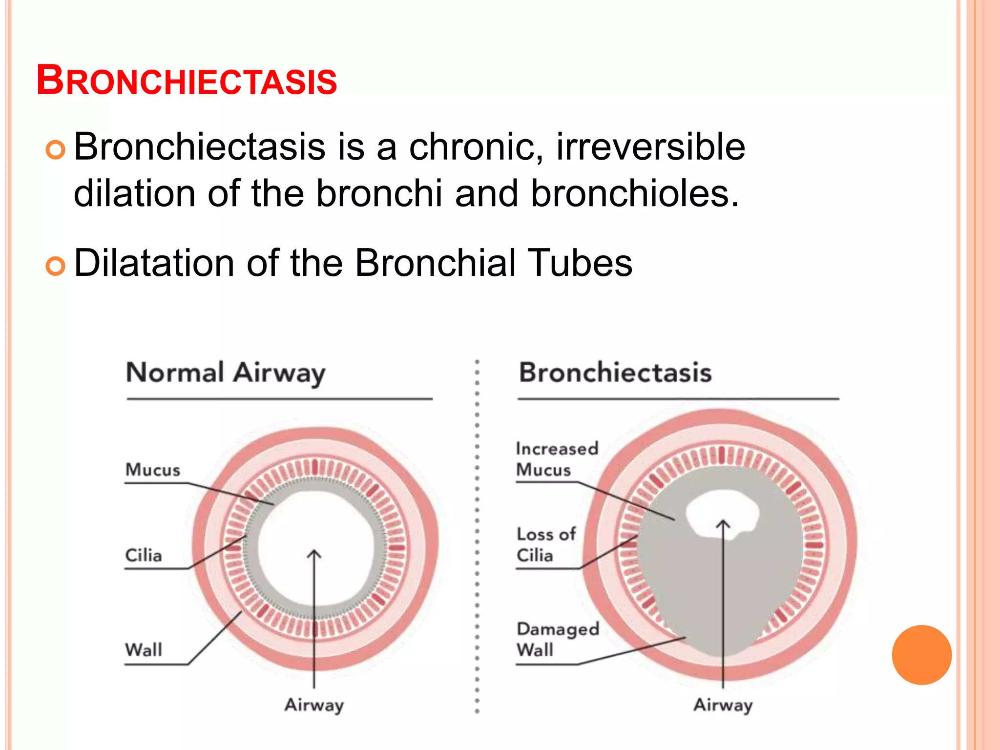 Bronchiectasis & Nursing care | PPTX