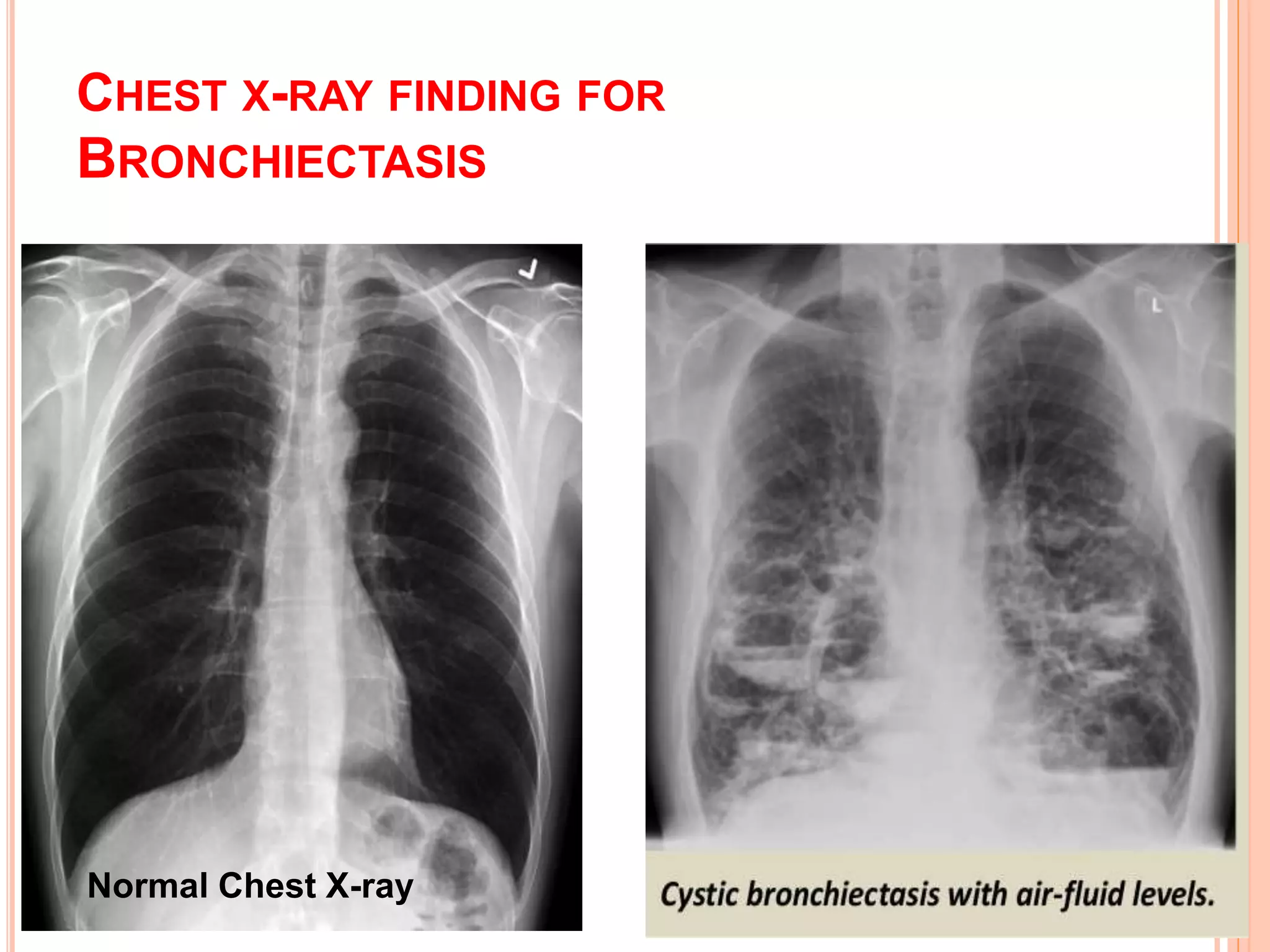 Bronchiectasis & Nursing care | PPTX