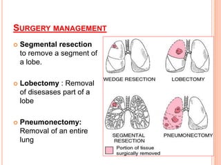 Bronchiectasis & Nursing care | PPTX