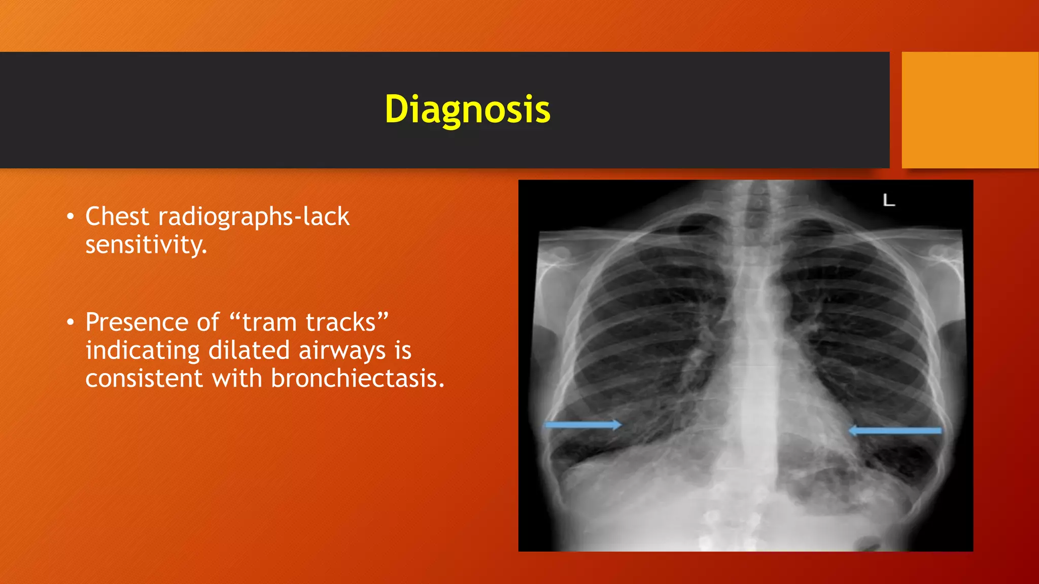 Bronchiectasis | PPTX