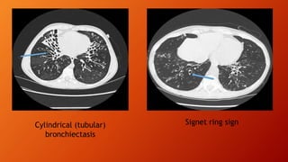 Bronchiectasis | PPTX