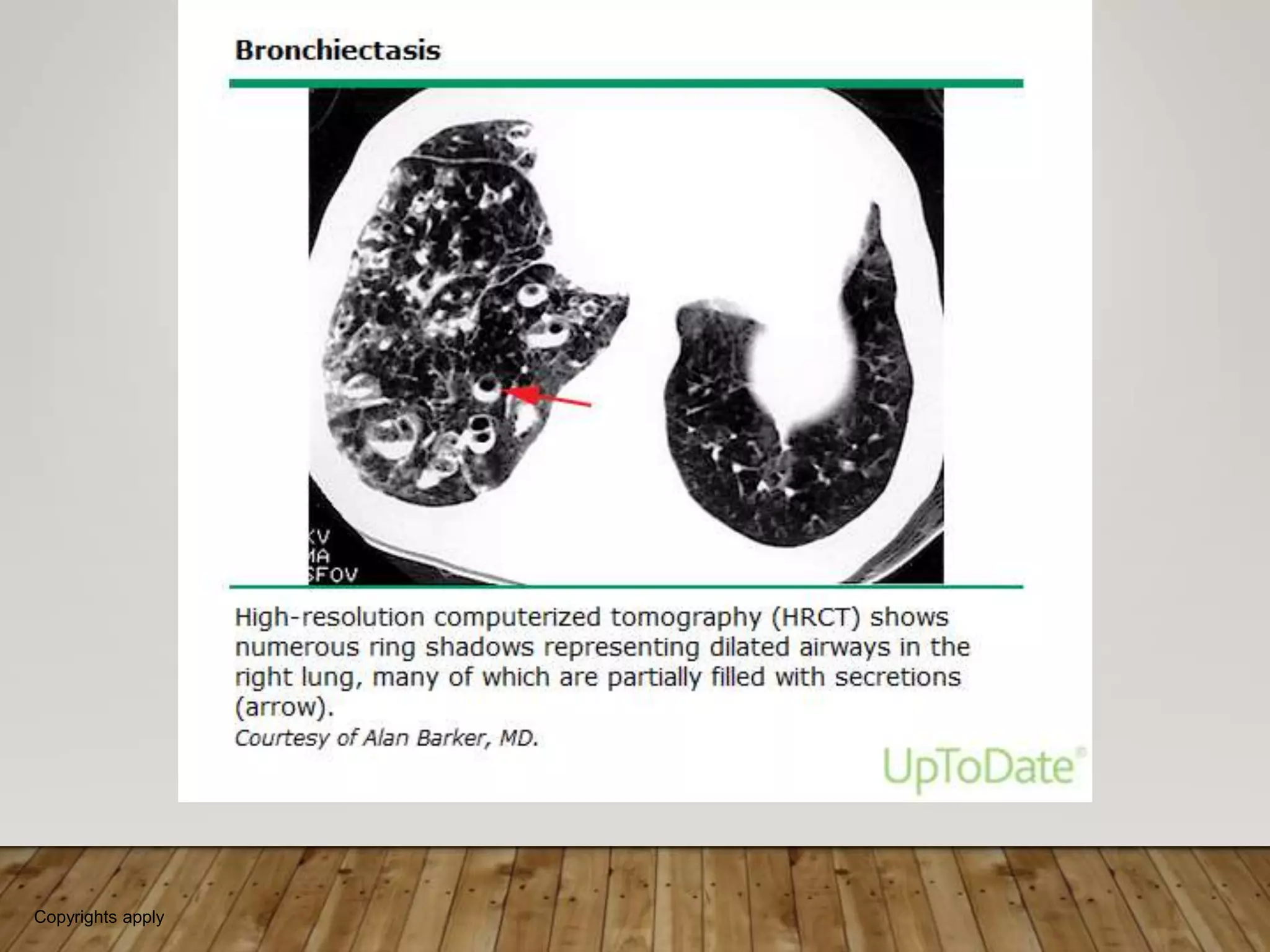 bronchiectasis.ppt