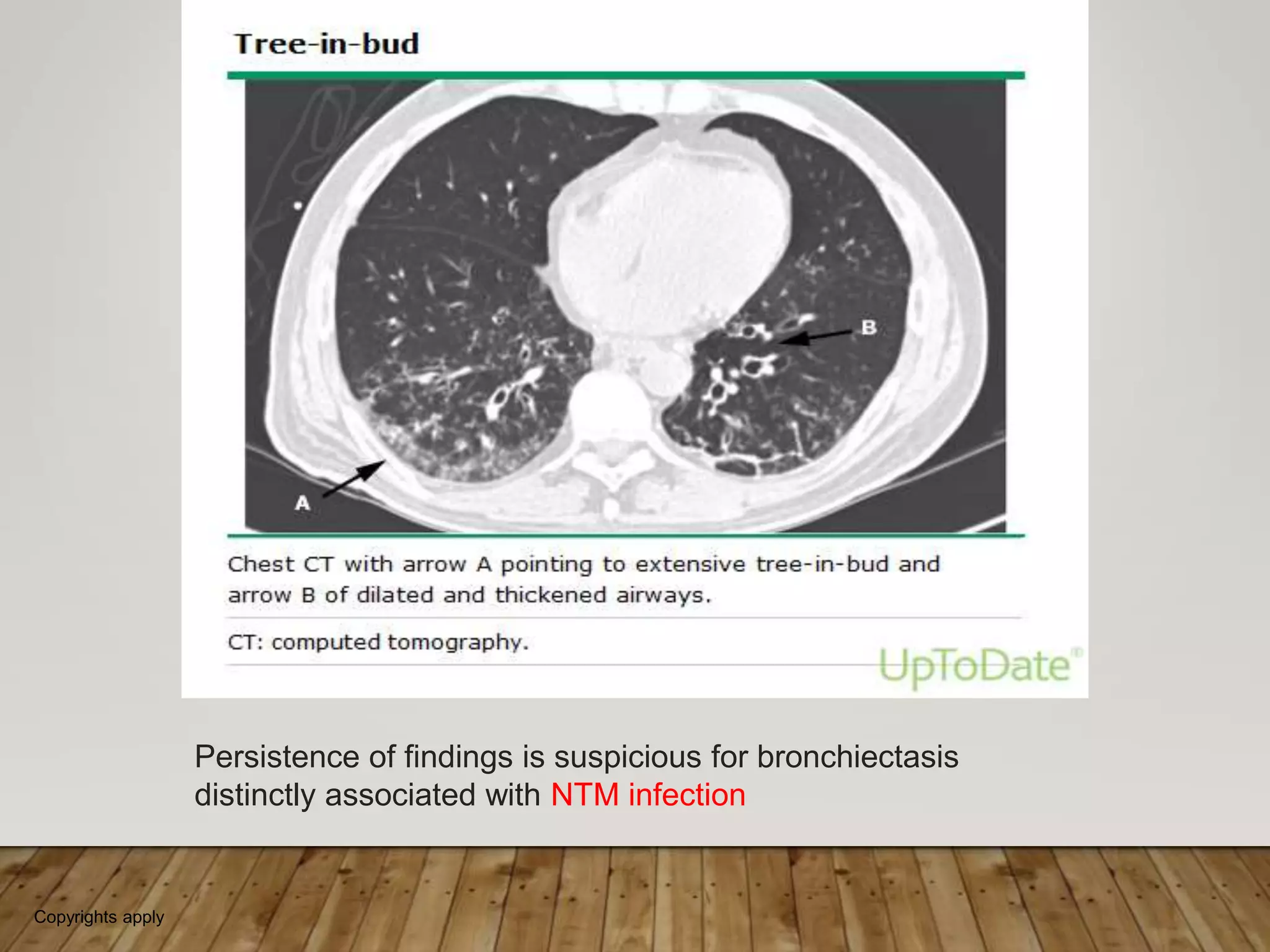 bronchiectasis.ppt