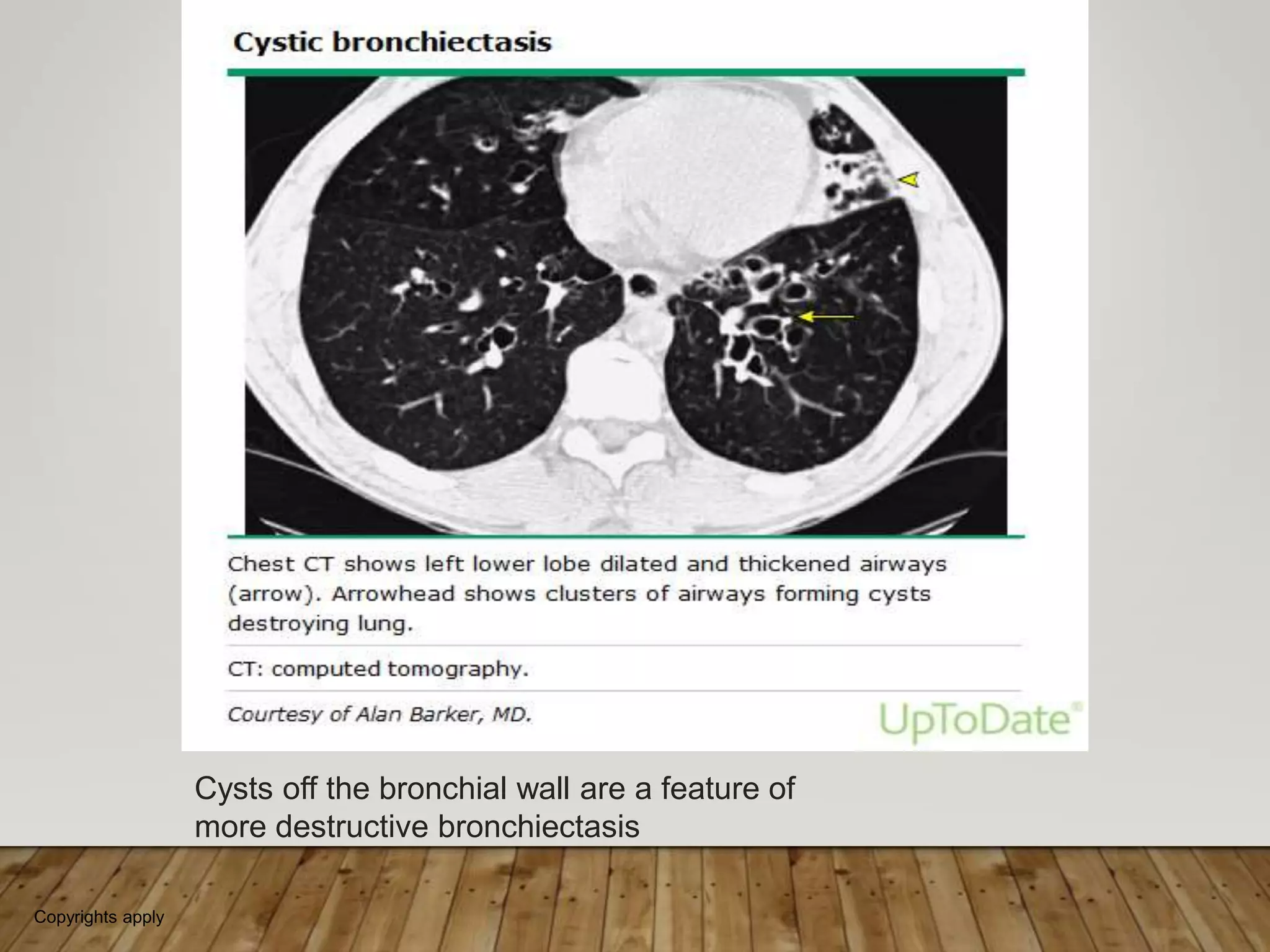 bronchiectasis.ppt