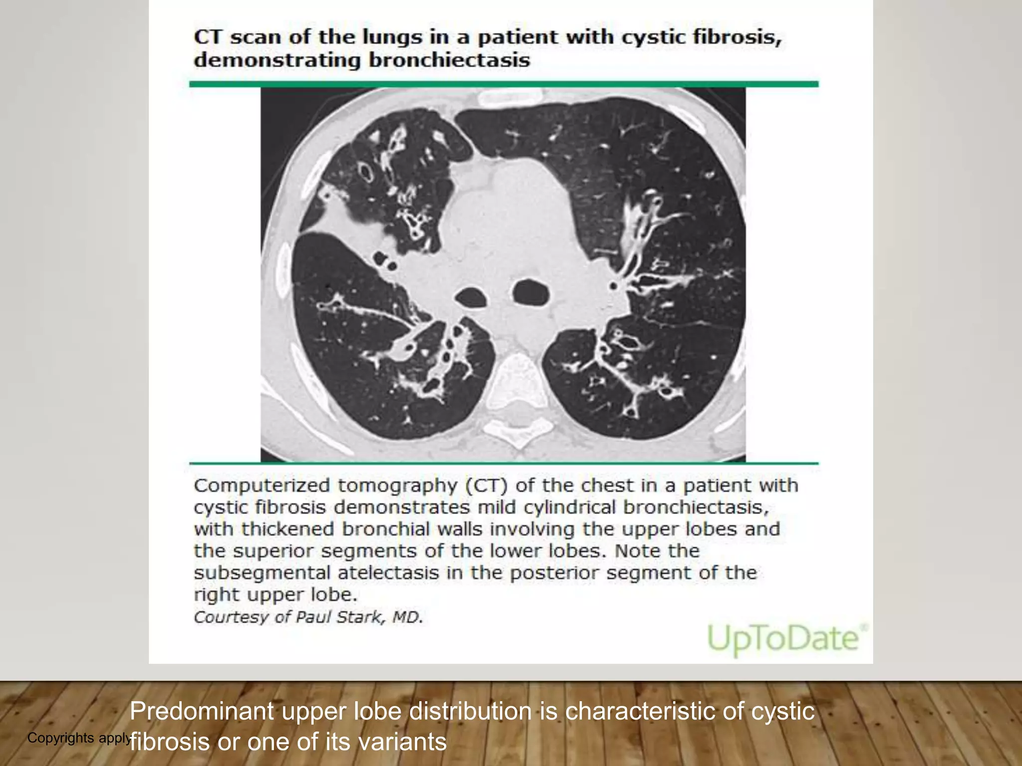 bronchiectasis.ppt