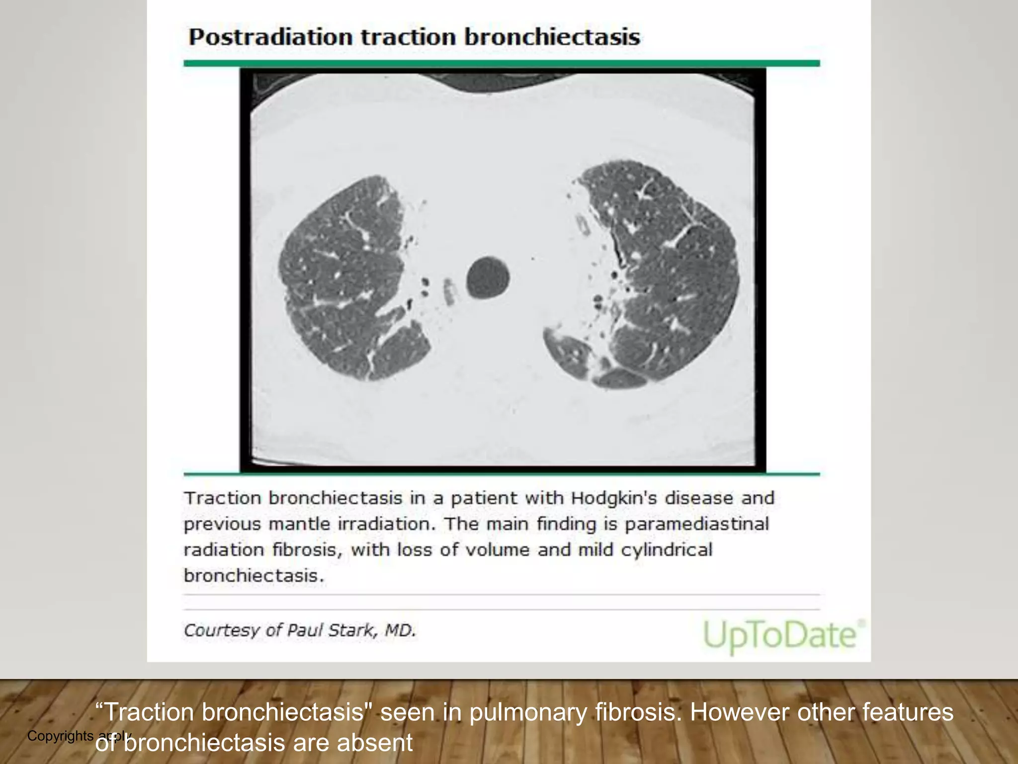 bronchiectasis.ppt