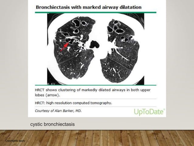 bronchiectasis.ppt