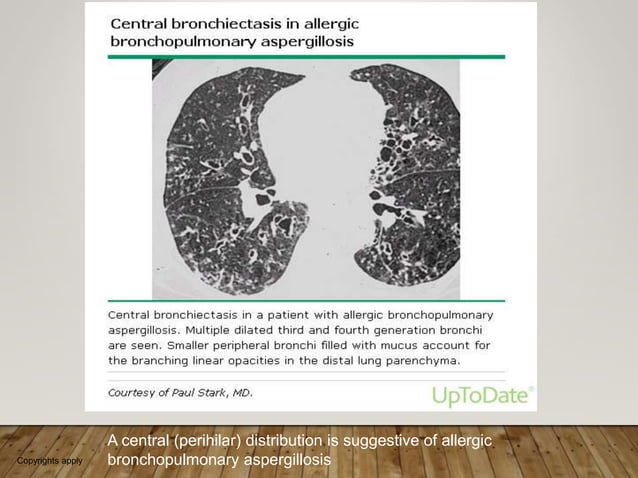 bronchiectasis.ppt