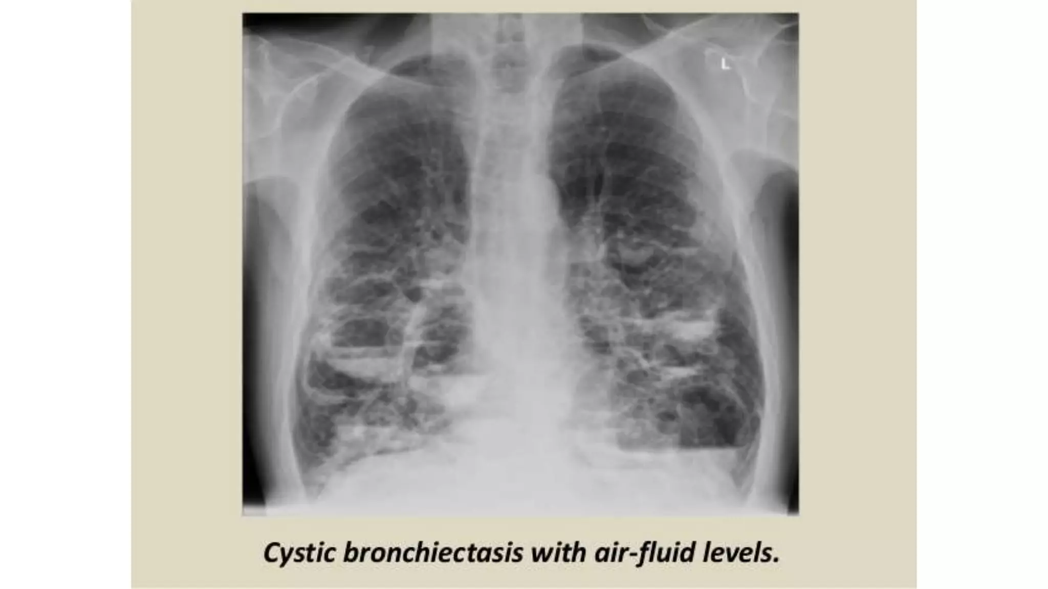 Bronchiectasis Pptx Lung And Respiratory Health Diseases And Conditions