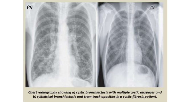 Bronchiectasis Pptx