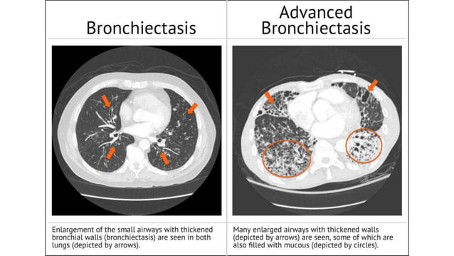 Bronchiectasis .pptx
