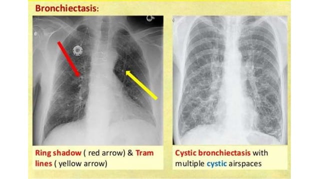 Bronchiectasis .pptx