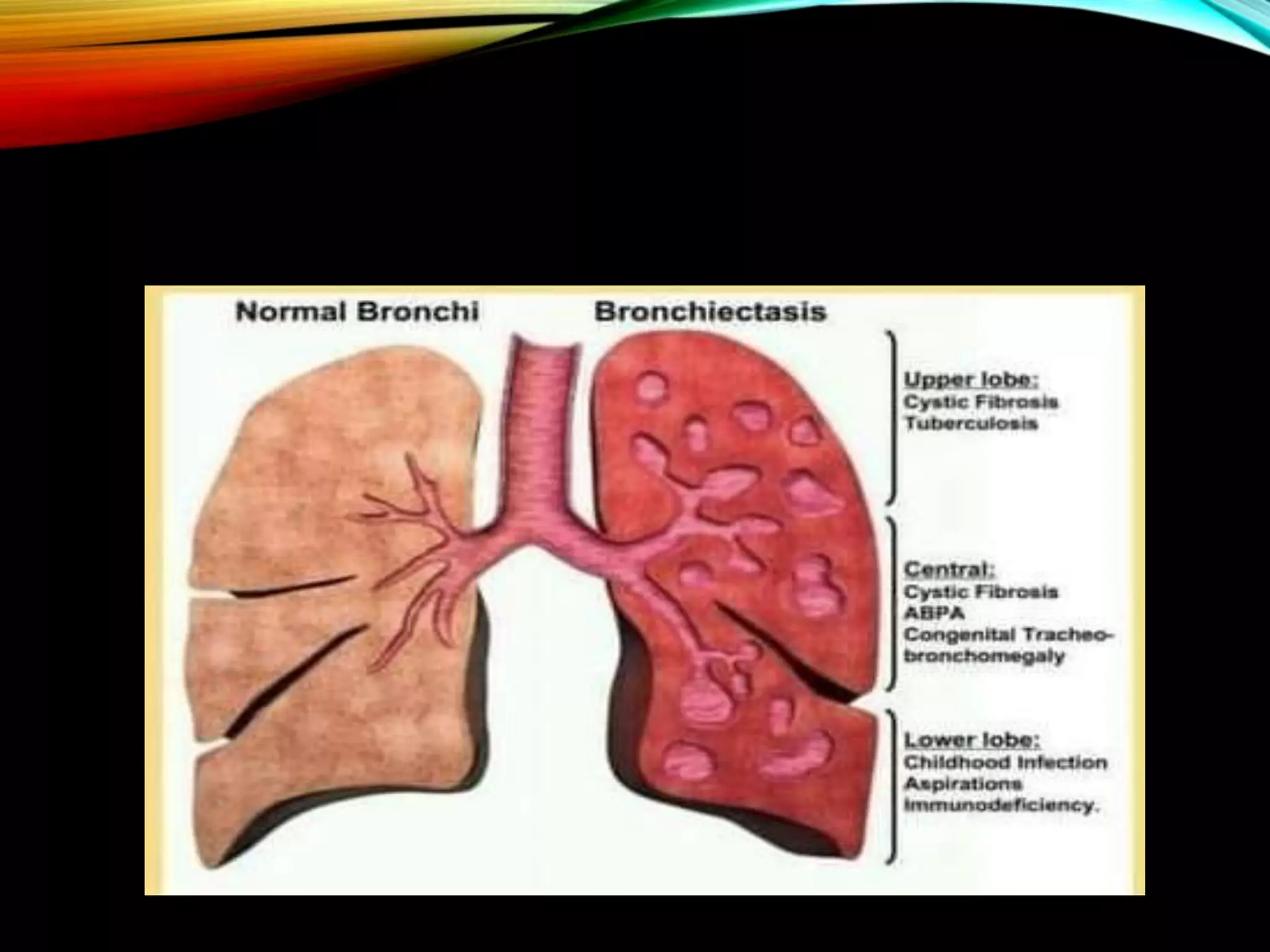 Bronchiectasis.ppt