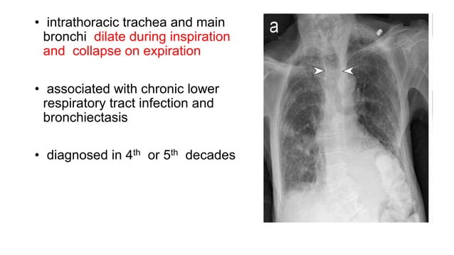 BRONCHIECTASIS.pptx