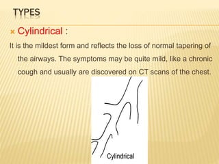 bronchiectasis.pptx