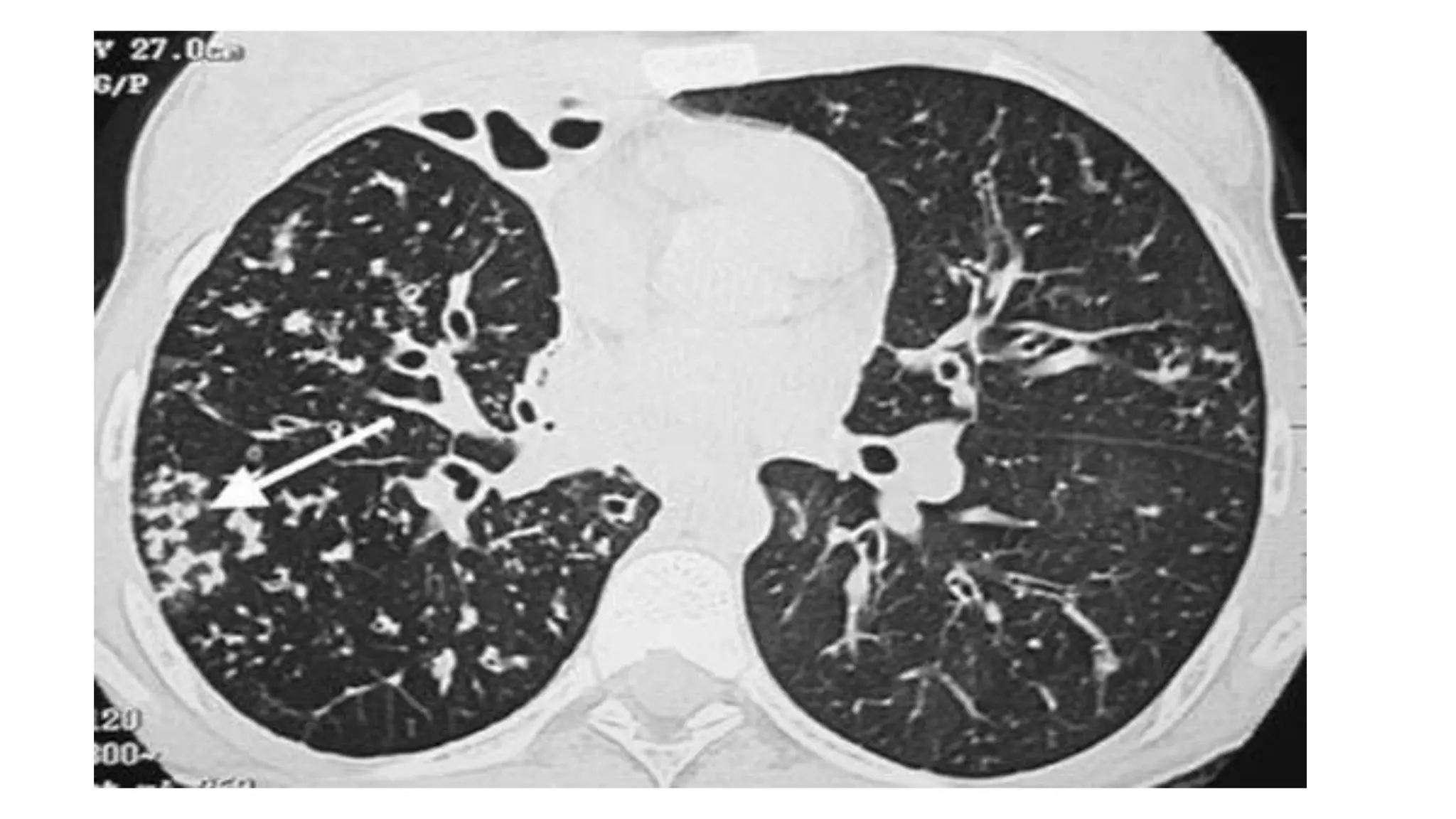 Bronchiectasis.pptx