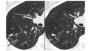 Bronchiectasis.pptx