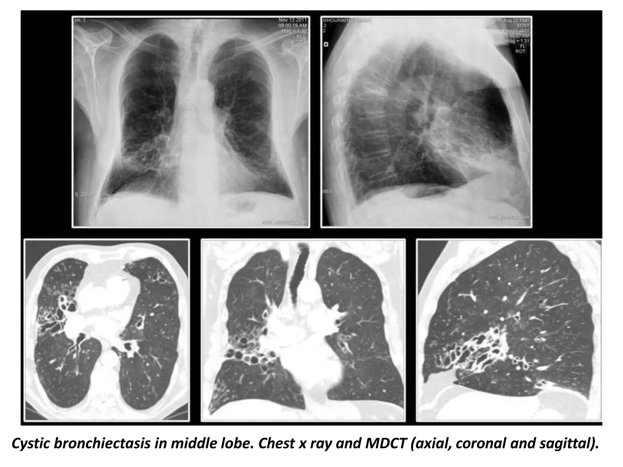 Bronchiectasis.pptx
