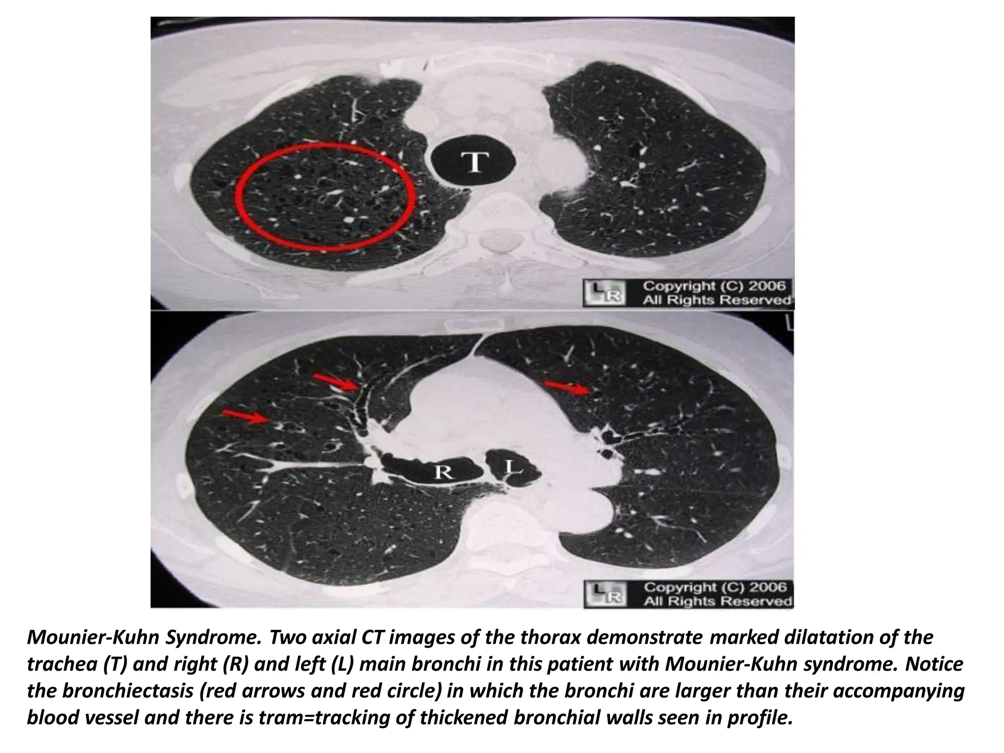 Bronchiectasis.pptx