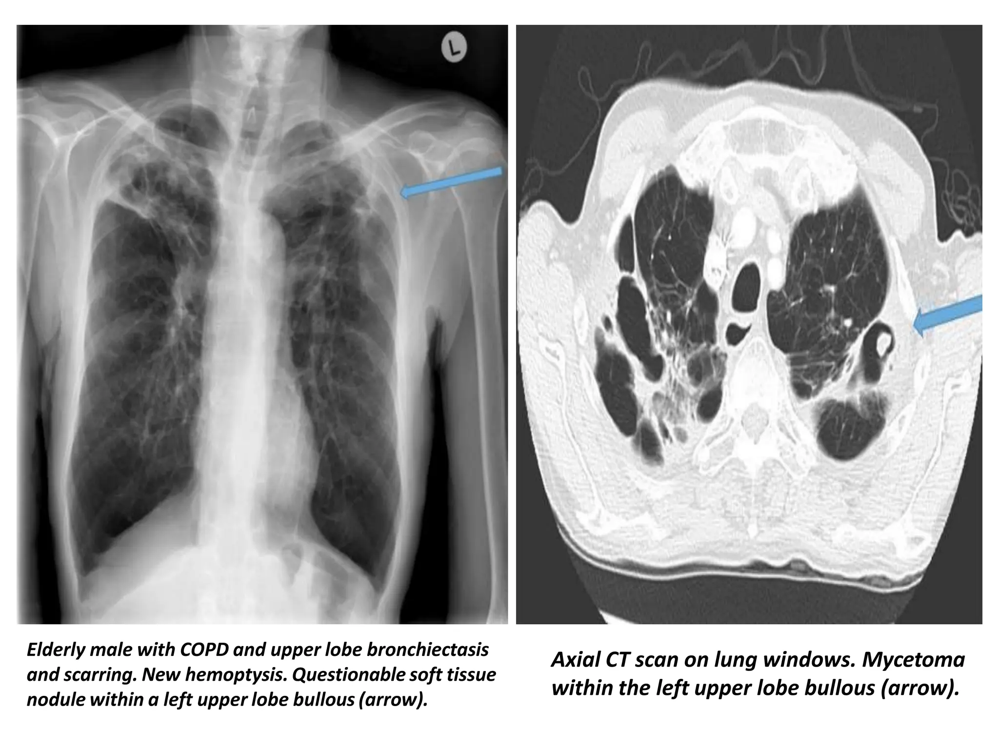 Bronchiectasis.pptx