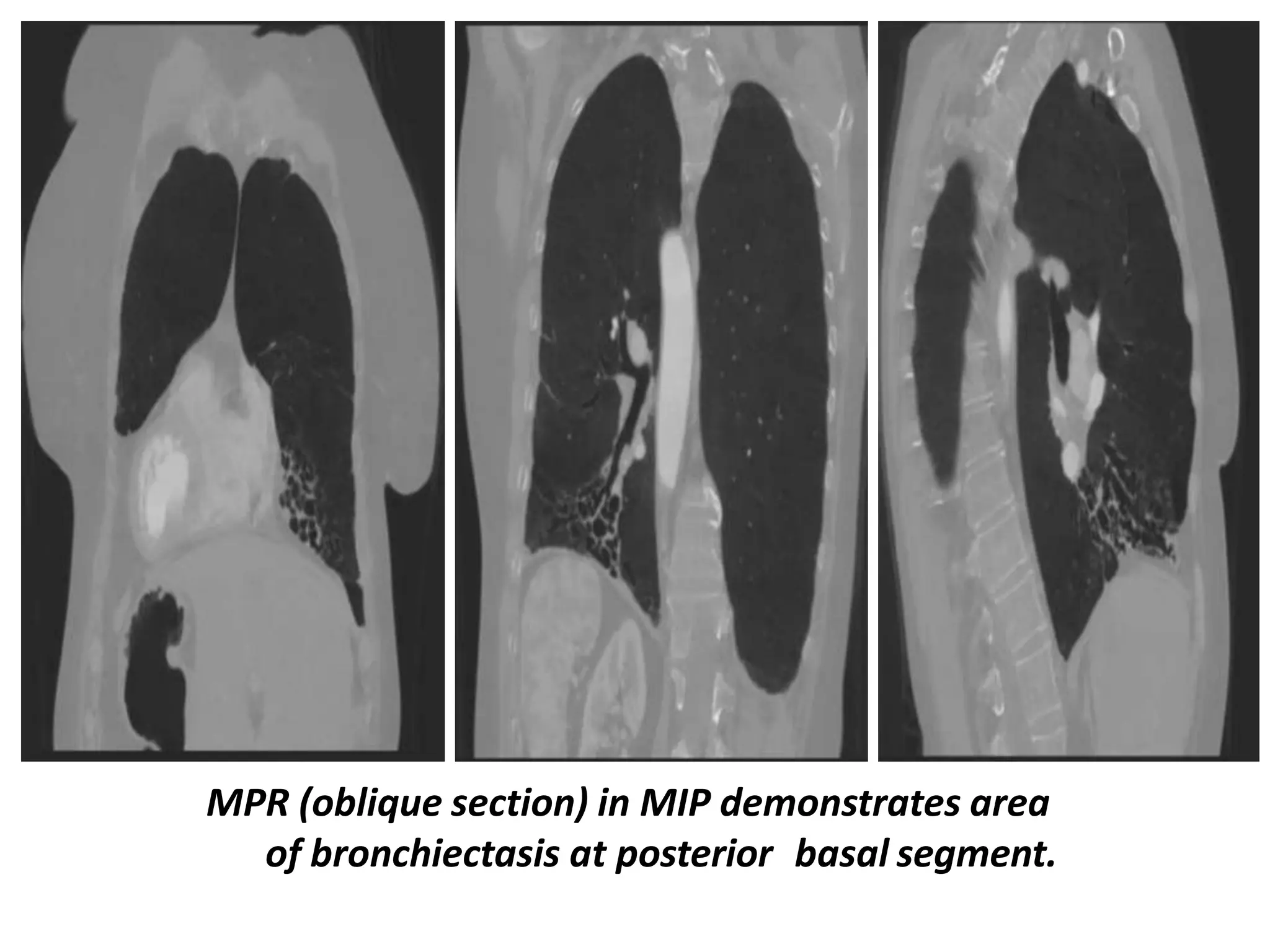 Bronchiectasis.pptx