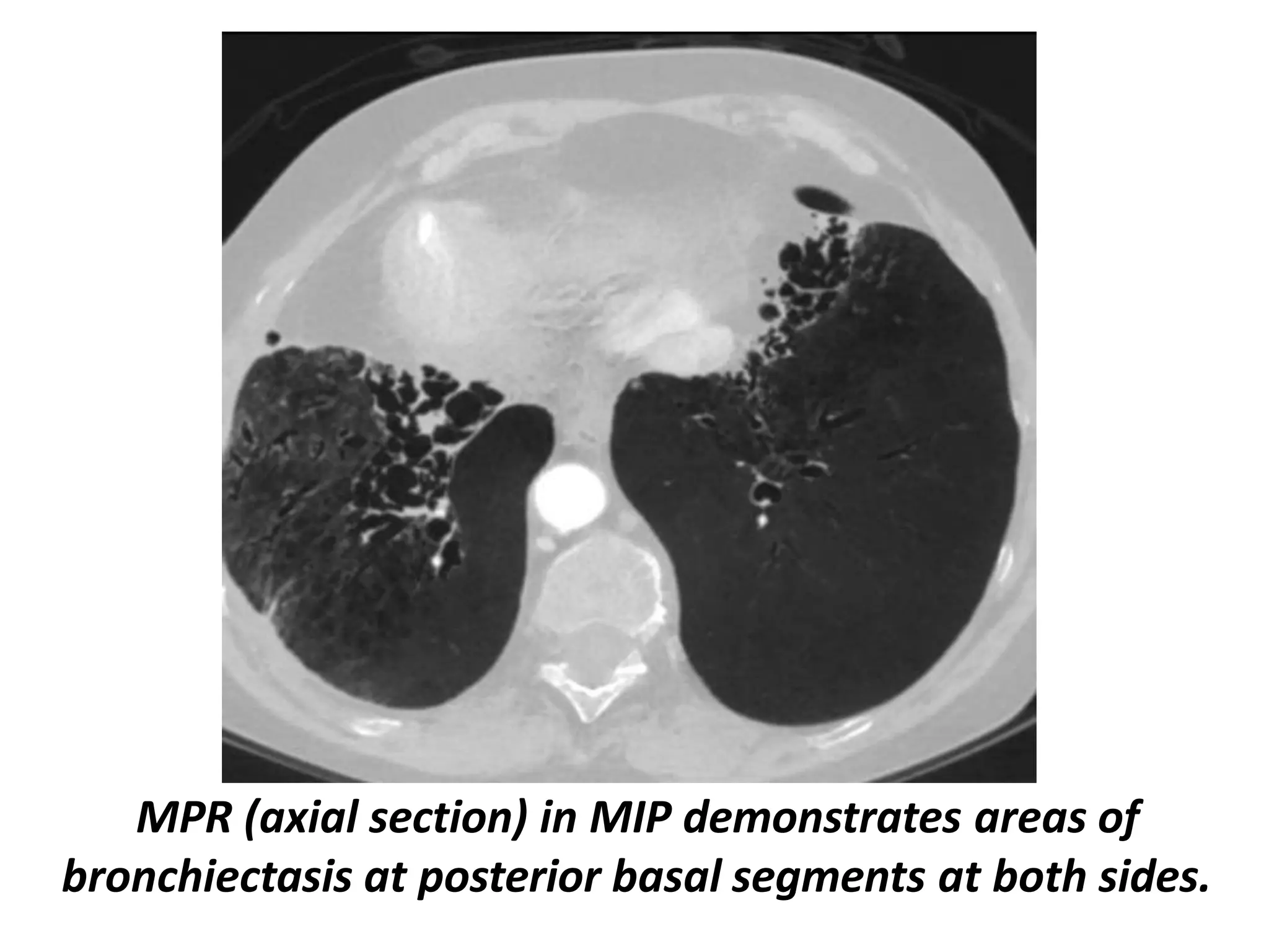 Bronchiectasis.pptx