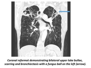 Bronchiectasis.pptx
