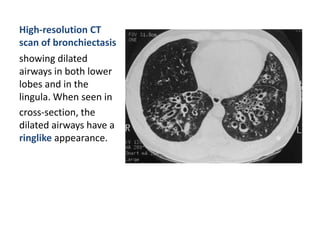 BRONCHIECTASIS.pptx