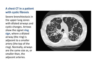 BRONCHIECTASIS.pptx