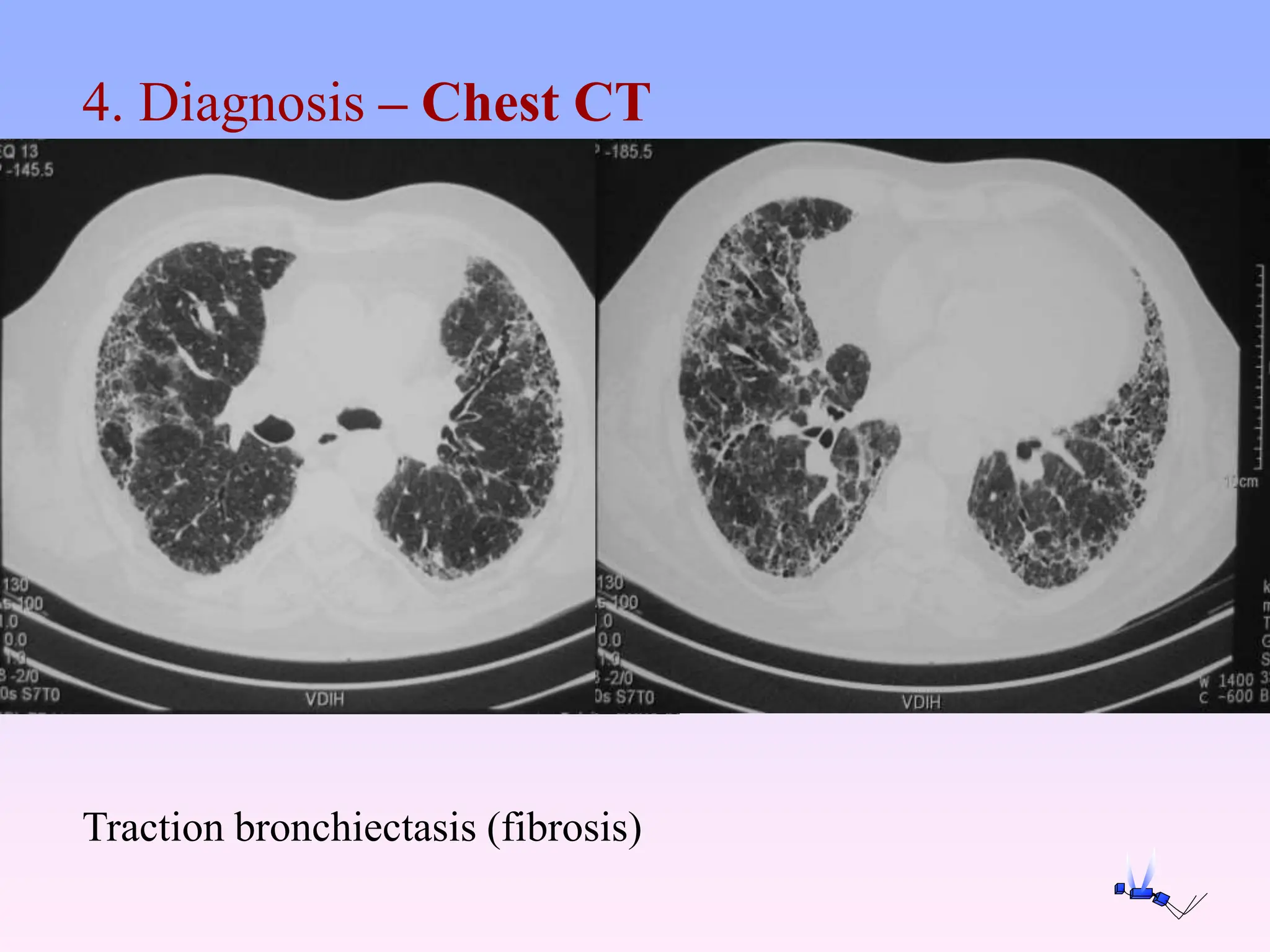 Bronchiectasis lecture for medical students .ppt
