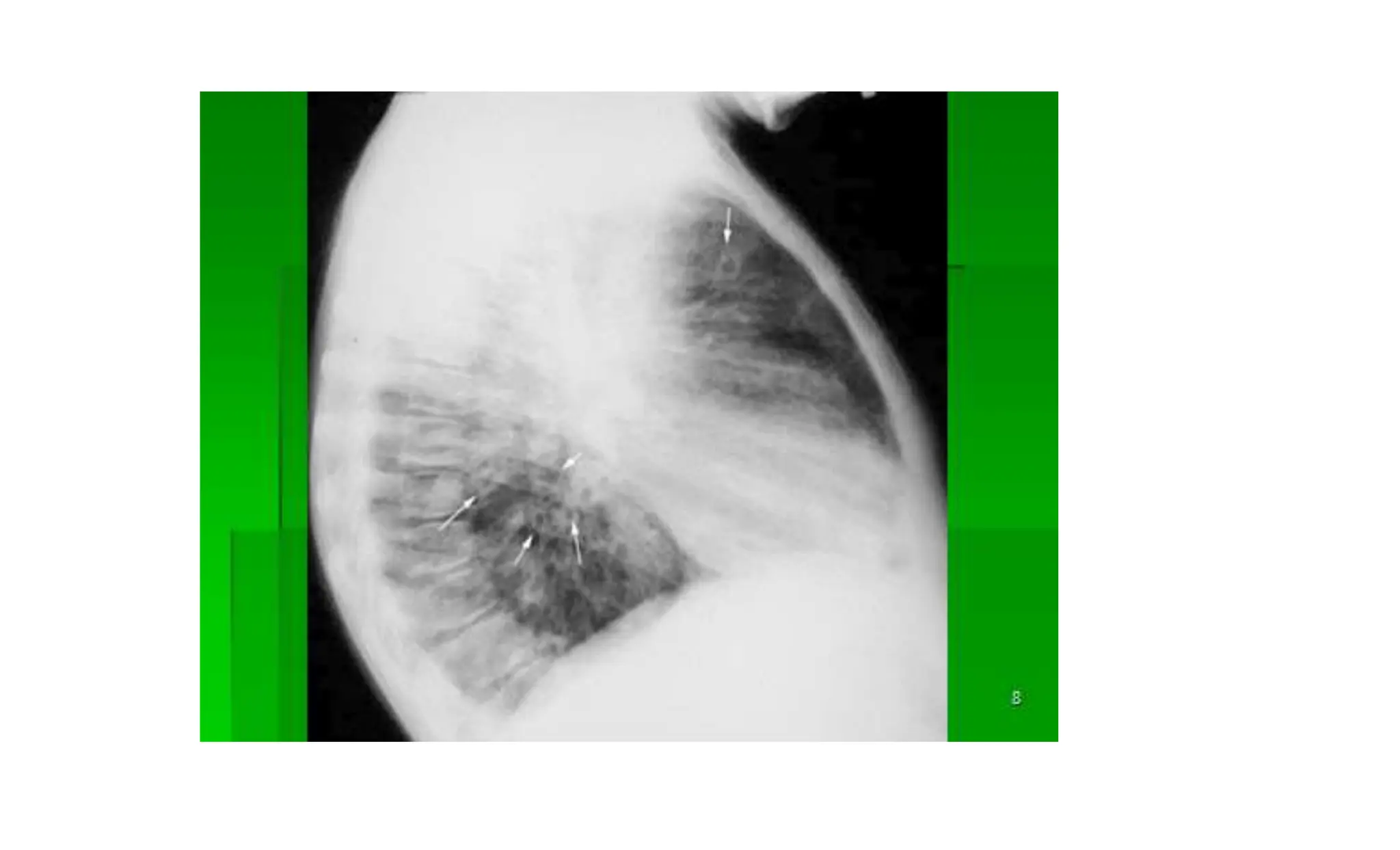 slide share on BRONCHIECTASIS.pptx