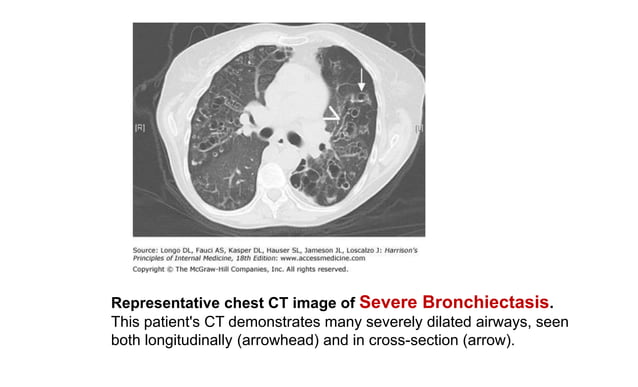 slide share on BRONCHIECTASIS.pptx