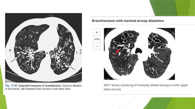Bronchiectasis- Etiology/Pathophysiology/Management | PPT