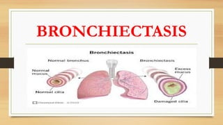 Bronchiectasis.pptx, definition, causes and risk factors, signs and ...