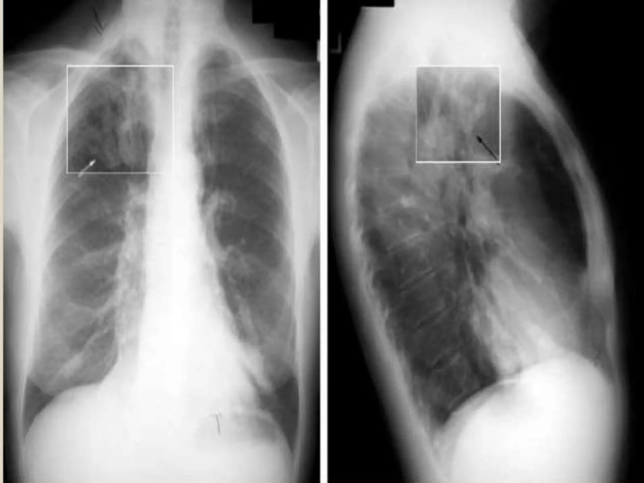 Bronchiectasis airway disease | PPTX
