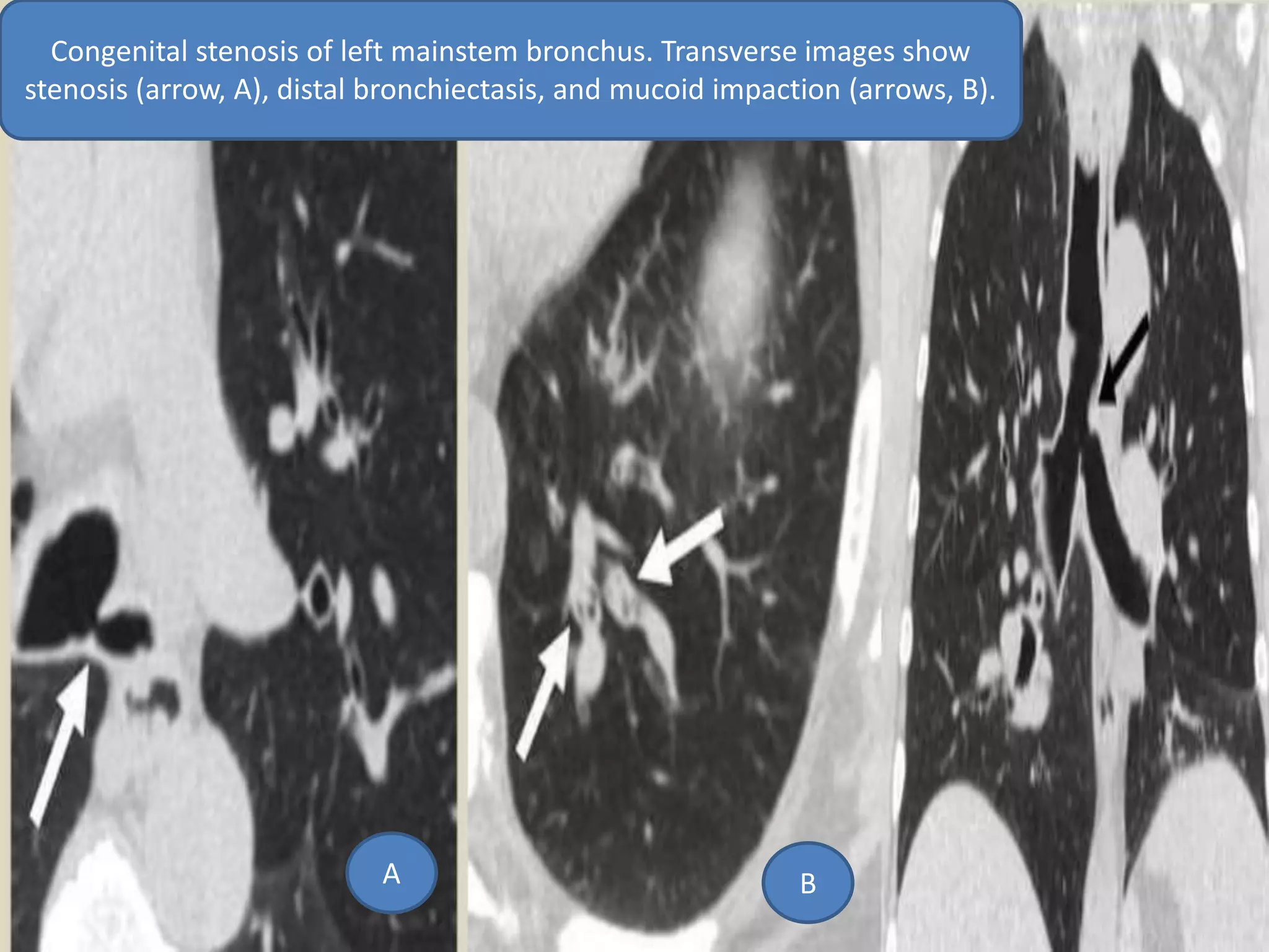 Bronchiectasis airway disease | PPT