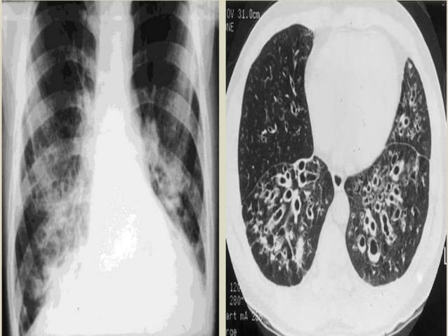 Bronchiectasis airway disease | PPT