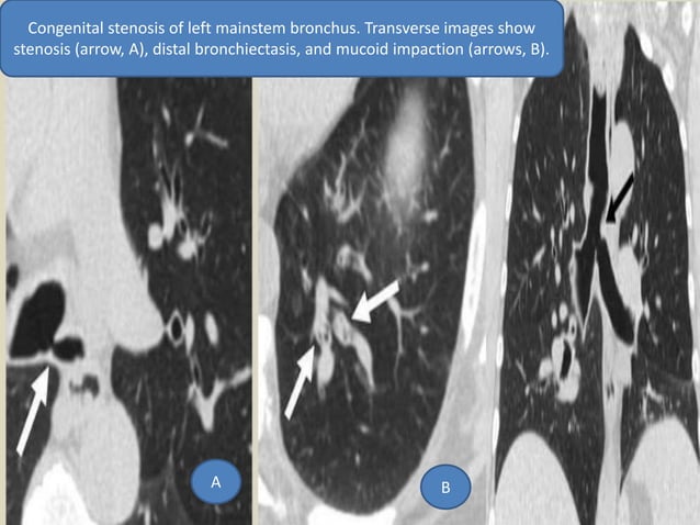 Bronchiectasis airway disease | PPT