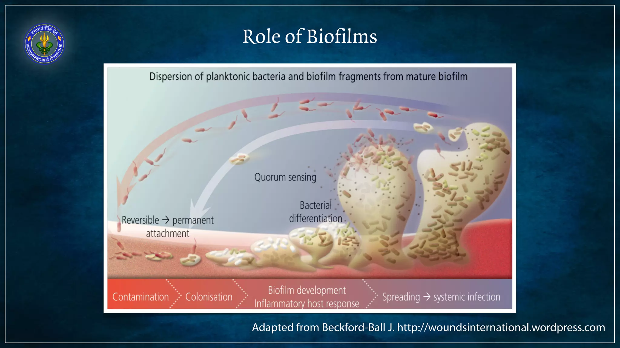 Bronchiectasis - causes and diagnosis | PDF